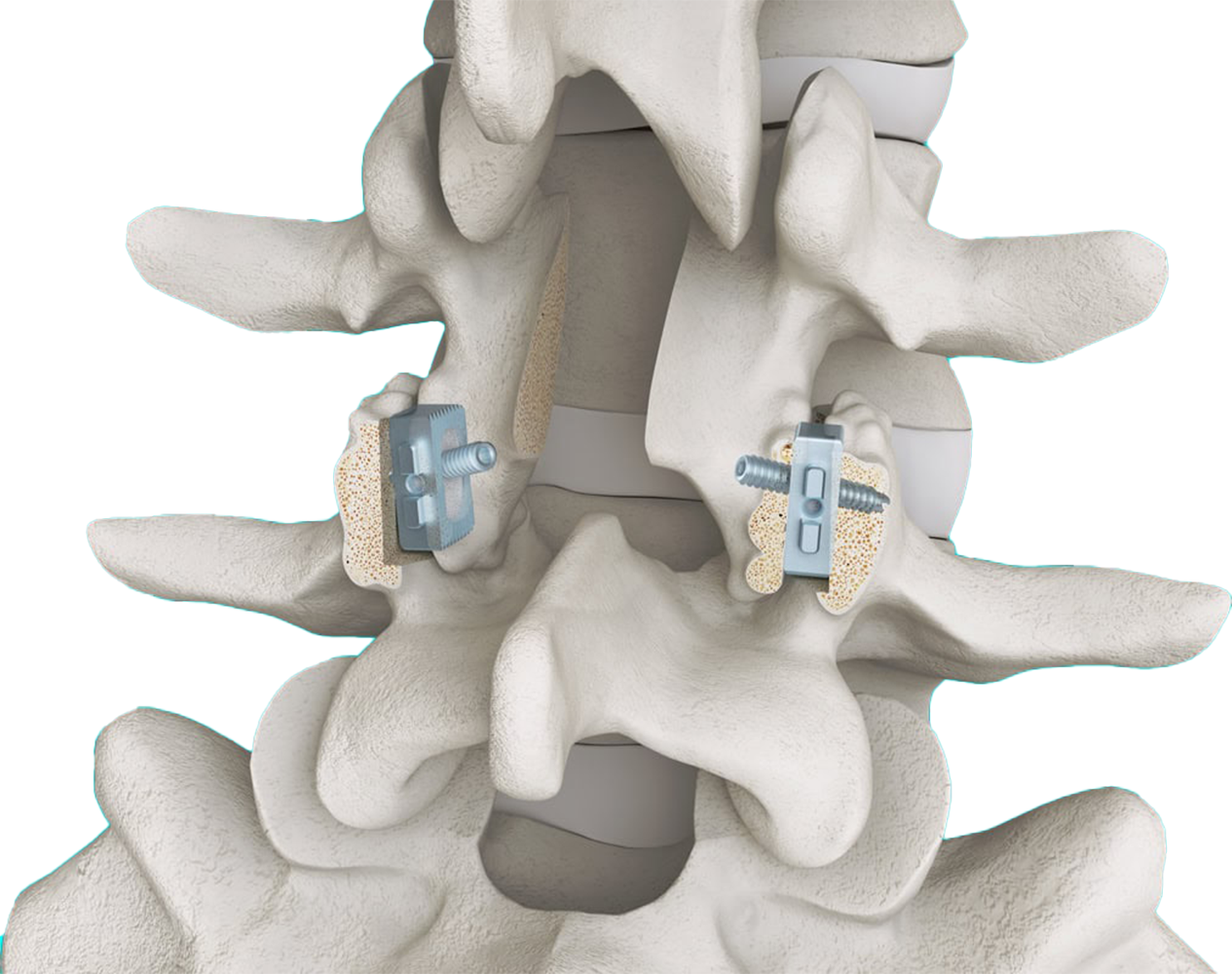 FFX® | Orthovative